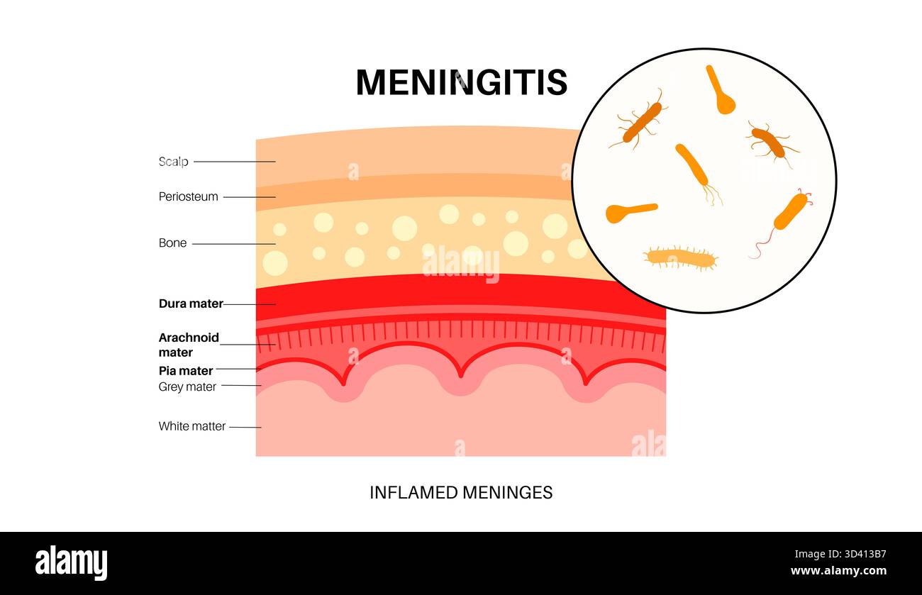Illustration of meningitis. This is an inflammation of the protective ...