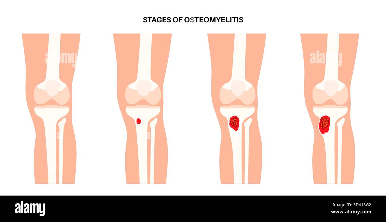 Illustration of tibia bone osteomyelitis. This is an infection of the ...