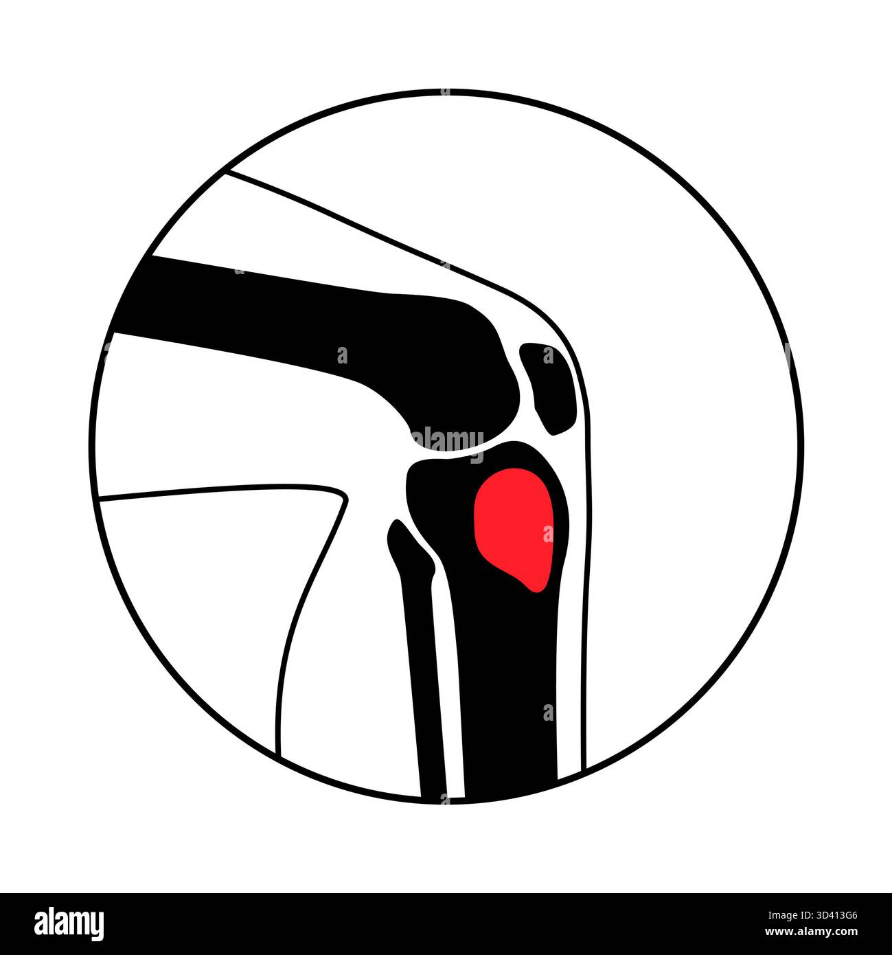 Illustration of tibia bone osteomyelitis. This is an infection of the ...