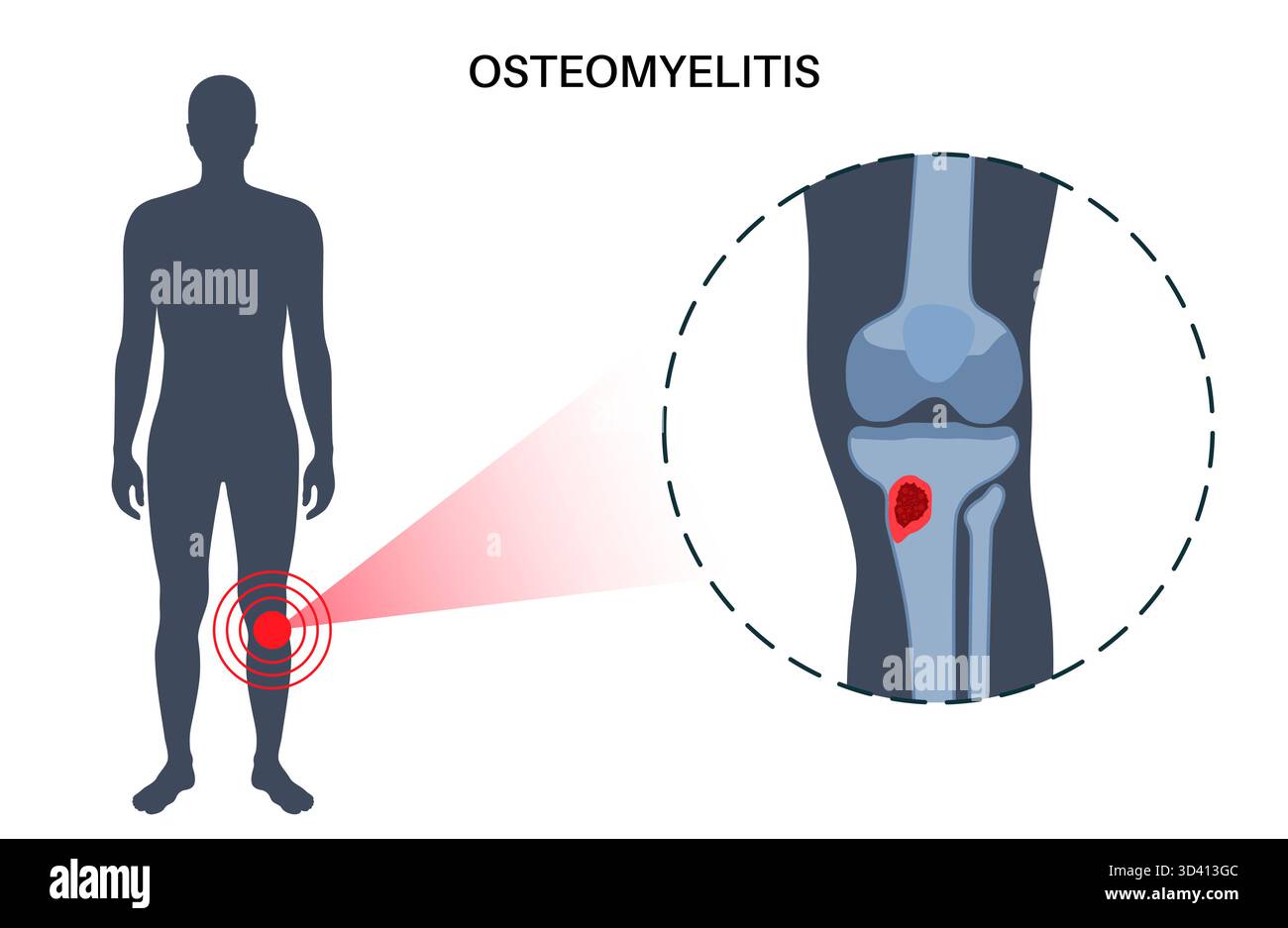 Illustration of tibia bone osteomyelitis. This is an infection of the ...