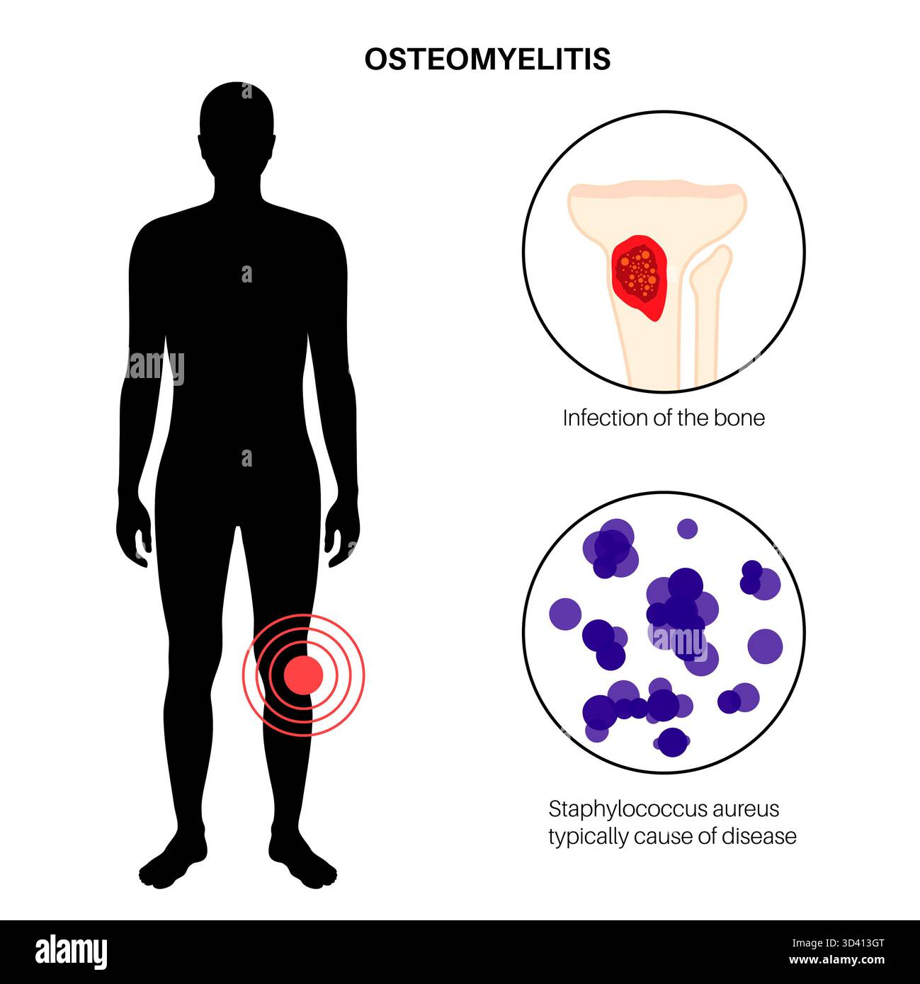 Illustration of tibia bone osteomyelitis. This is an infection of the ...