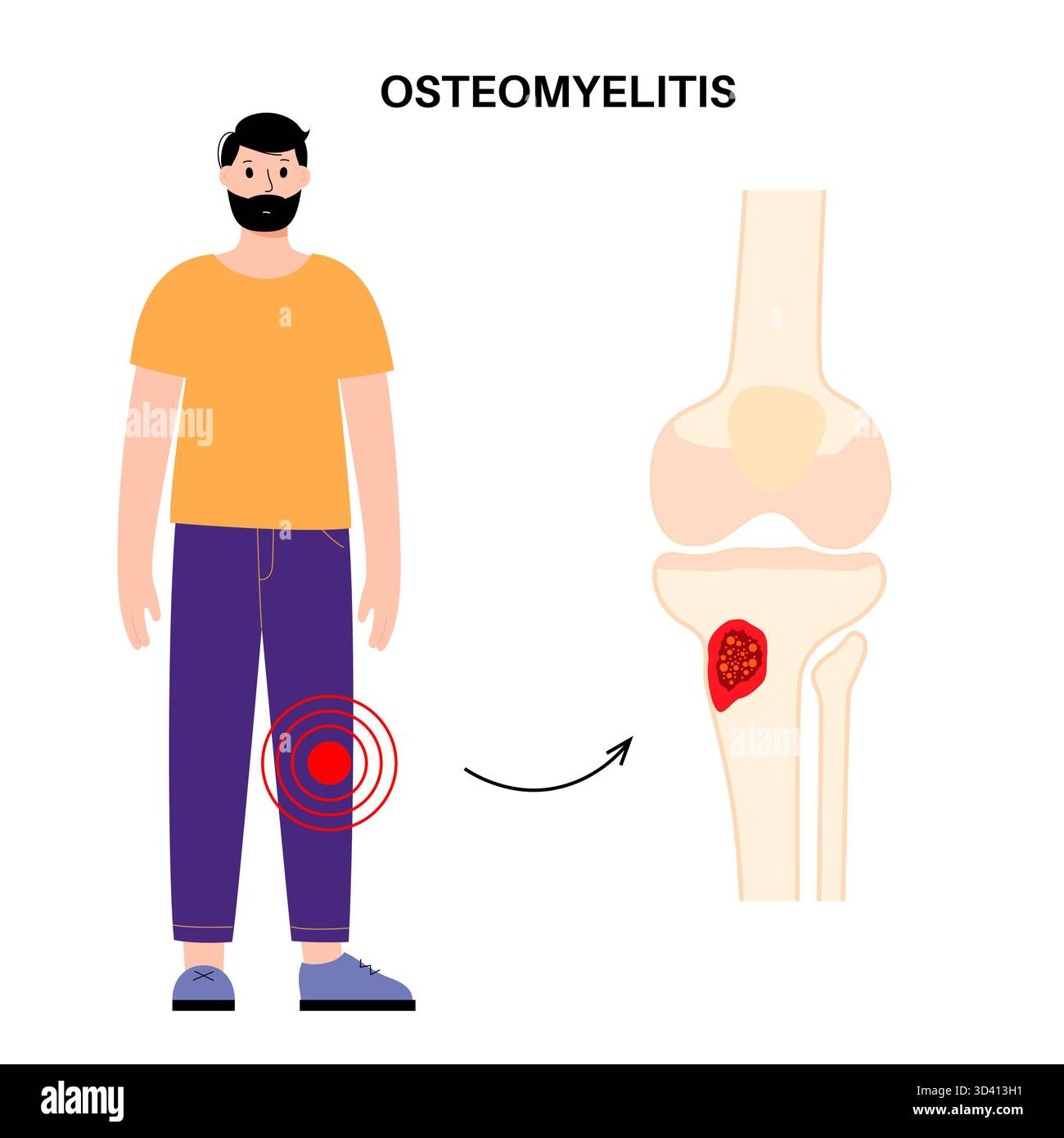 Illustration of tibia bone osteomyelitis. This is an infection of the ...
