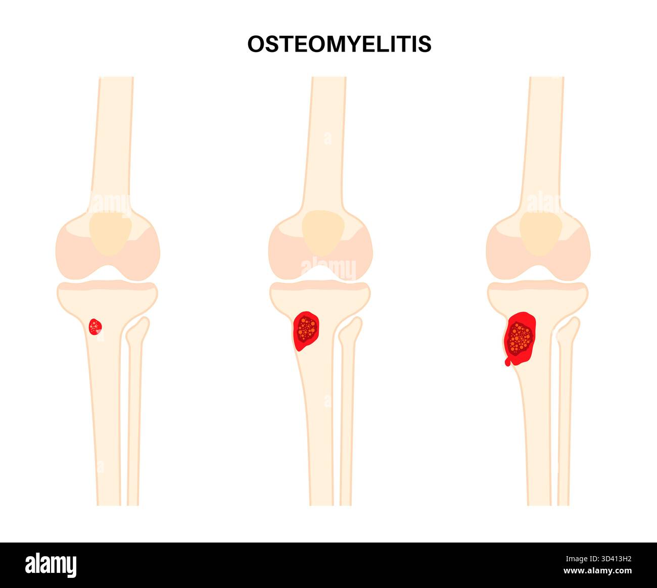 Illustration of tibia bone osteomyelitis. This is an infection of the ...