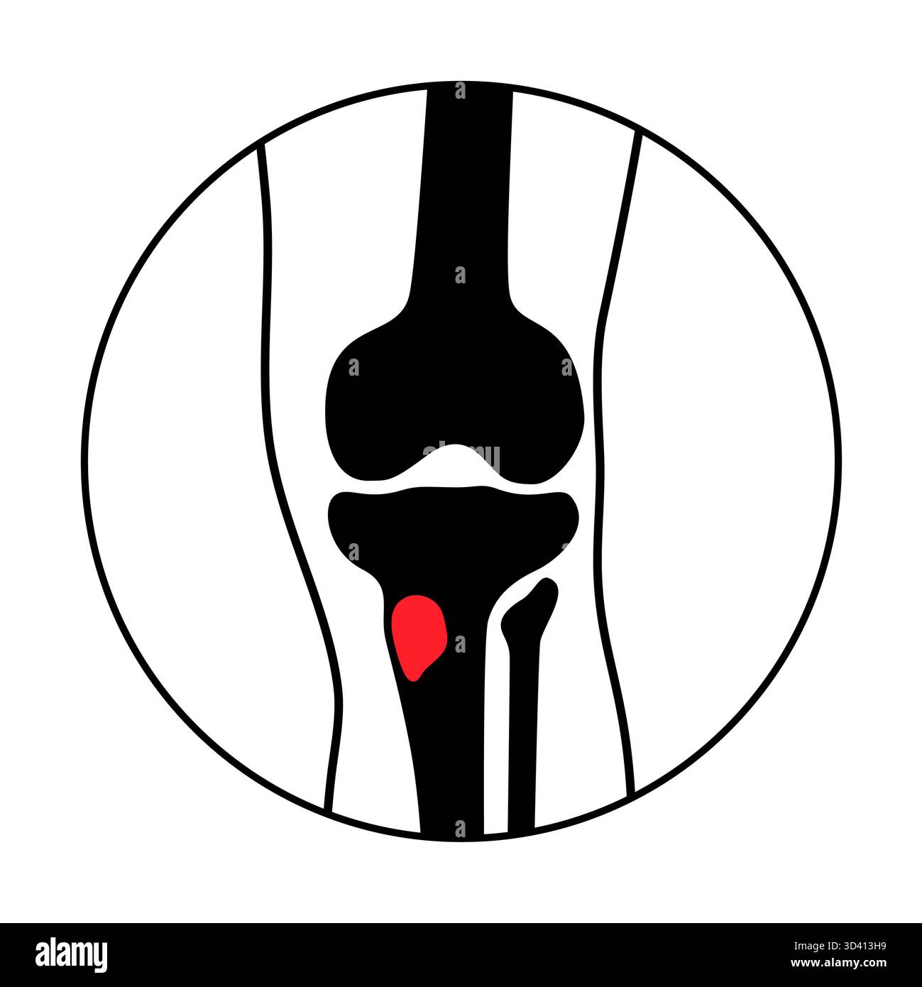 Illustration of tibia bone osteomyelitis. This is an infection of the ...
