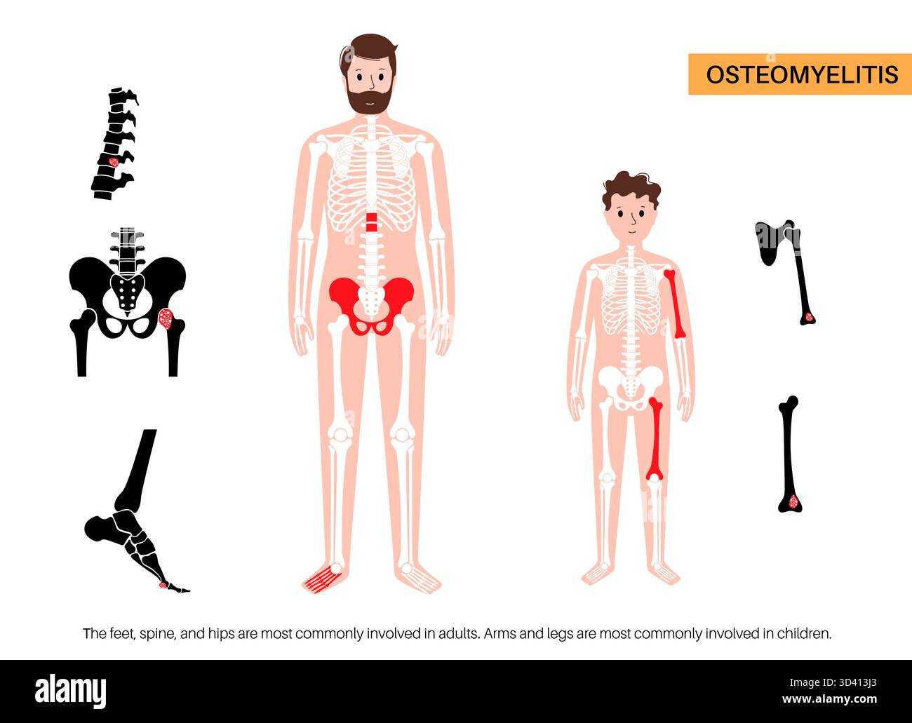 Illustration of osteomyelitis in adults and children. This is a serious ...
