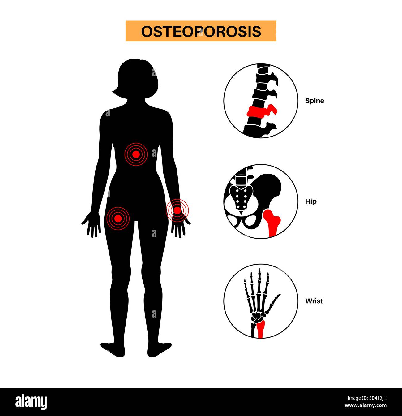 Osteoporosis disease poster. Systemic skeletal disorder of spine, wrist ...