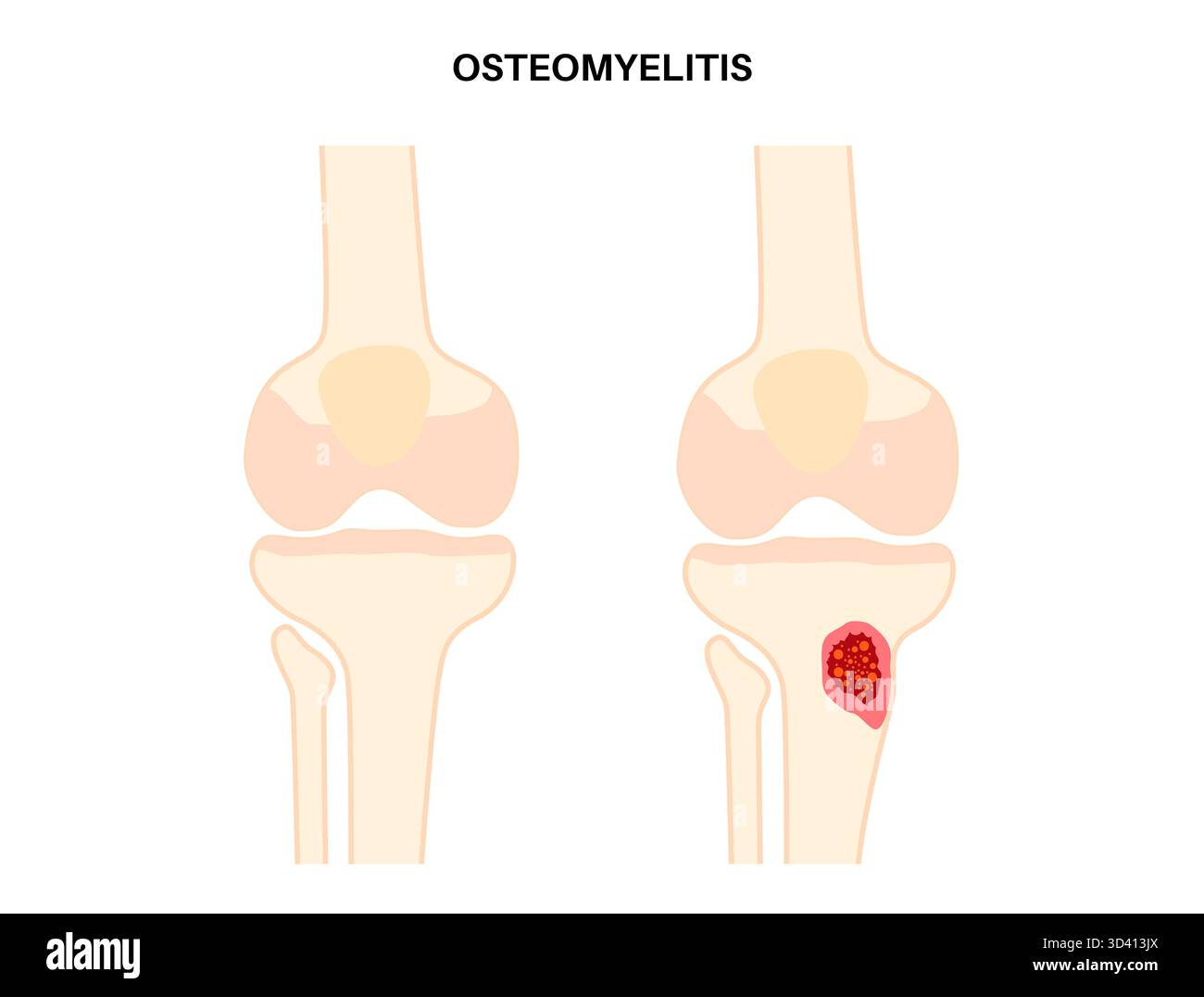 Illustration of tibia bone osteomyelitis. This is an infection of the ...
