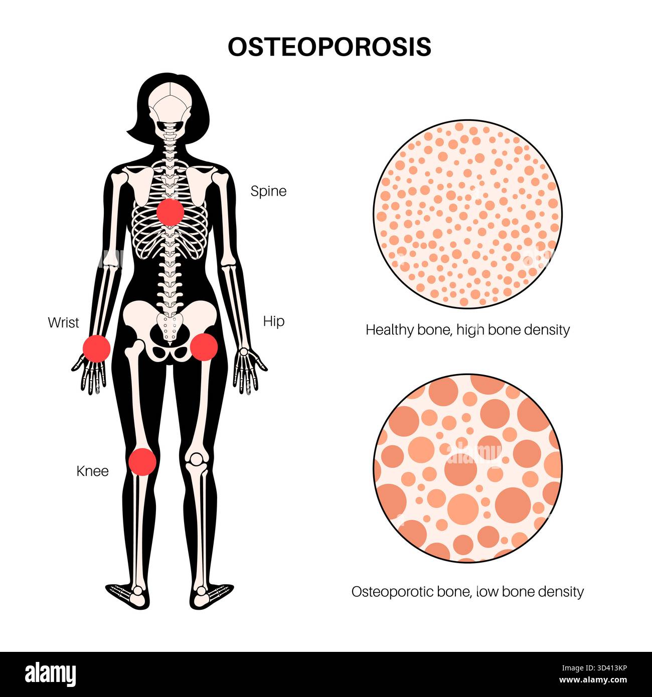 Illustration of osteoporosis. This is a condition that causes bones to ...