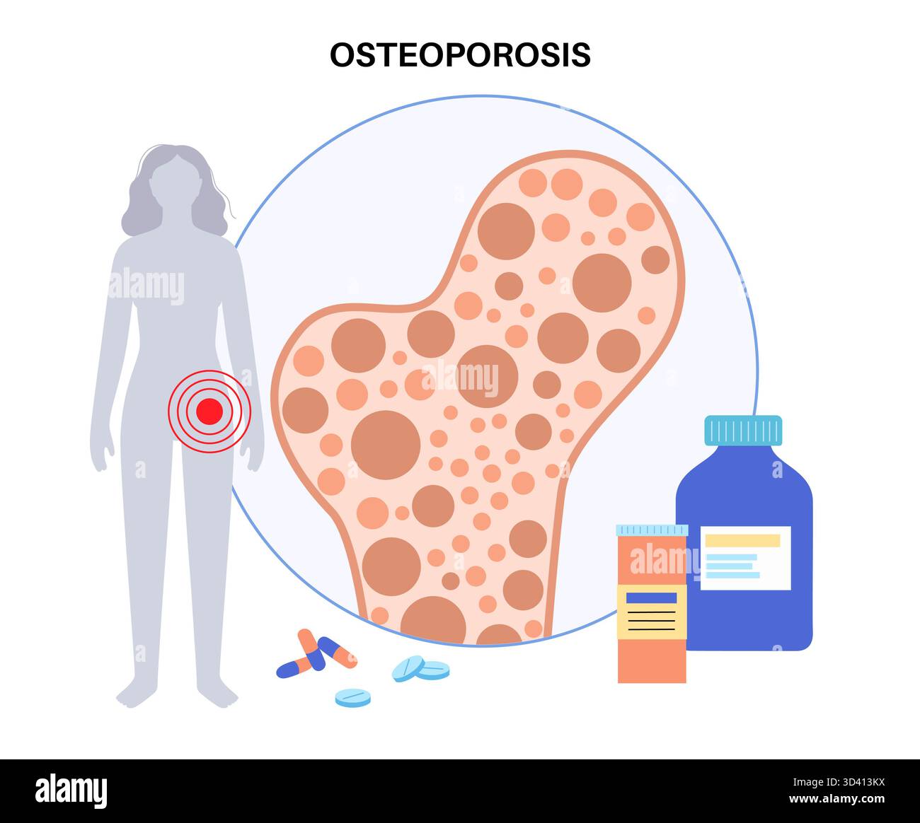 Illustration of osteoporosis treatment. This focuses on preventing ...