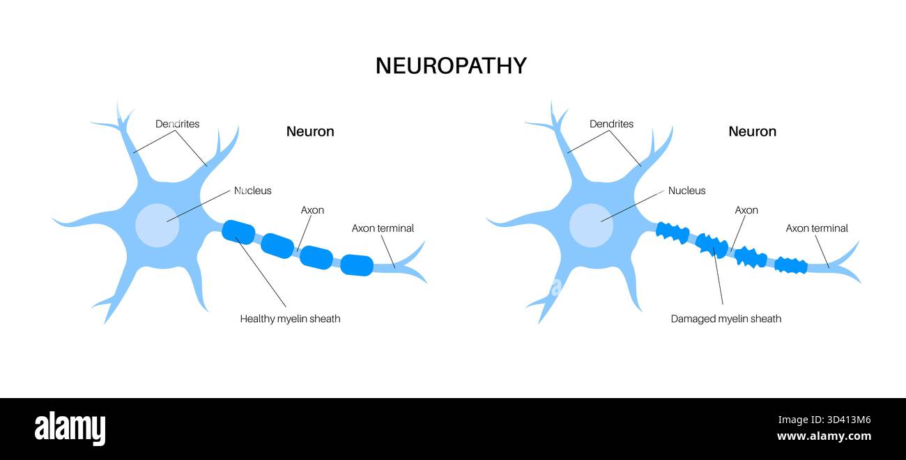 Illustration of peripheral neuropathy, a type of nerve damage in the ...