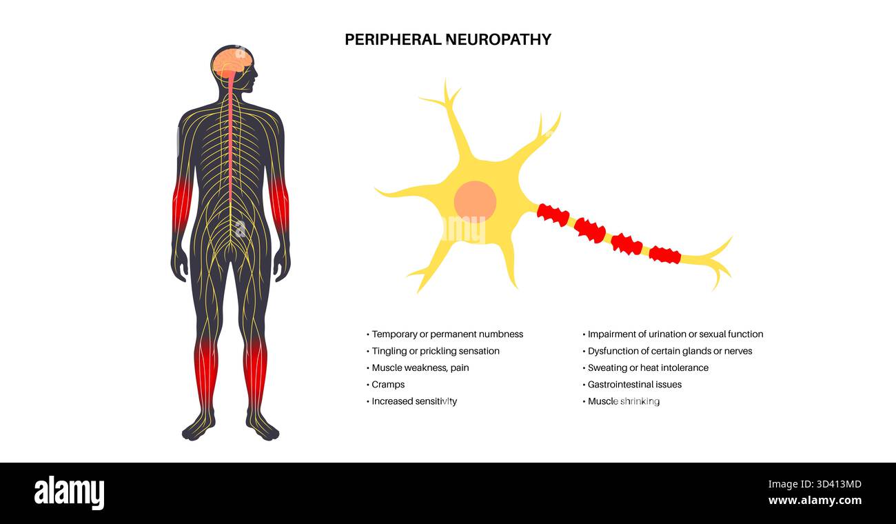 Illustration of peripheral neuropathy, a type of nerve damage in the ...