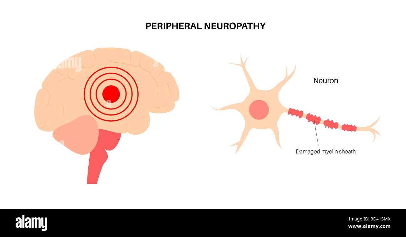 Illustration of peripheral neuropathy, a type of nerve damage in the ...