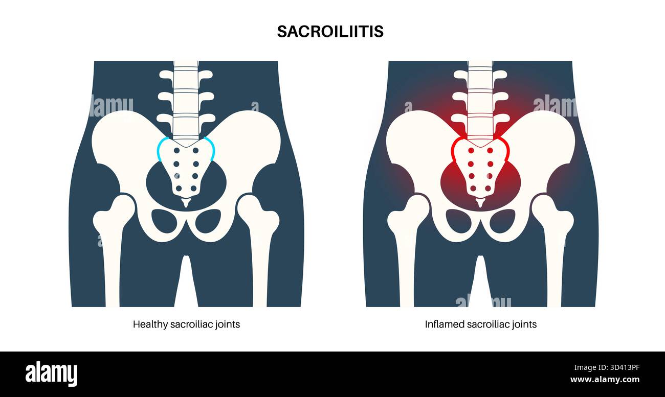 Illustration of sacroiliitis. This is an inflammatory condition that ...