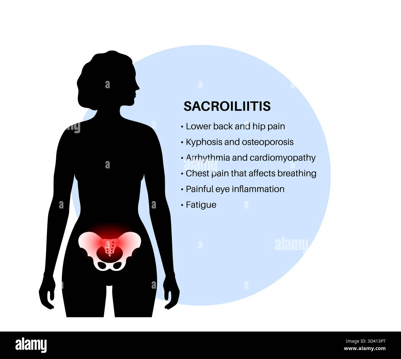 Illustration of sacroiliitis. This is an inflammatory condition that ...