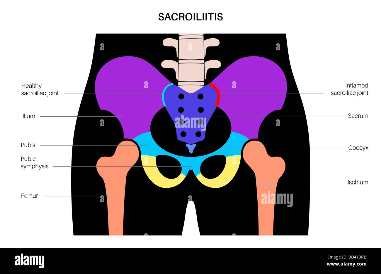 Illustration of sacroiliitis. This is an inflammatory condition that ...