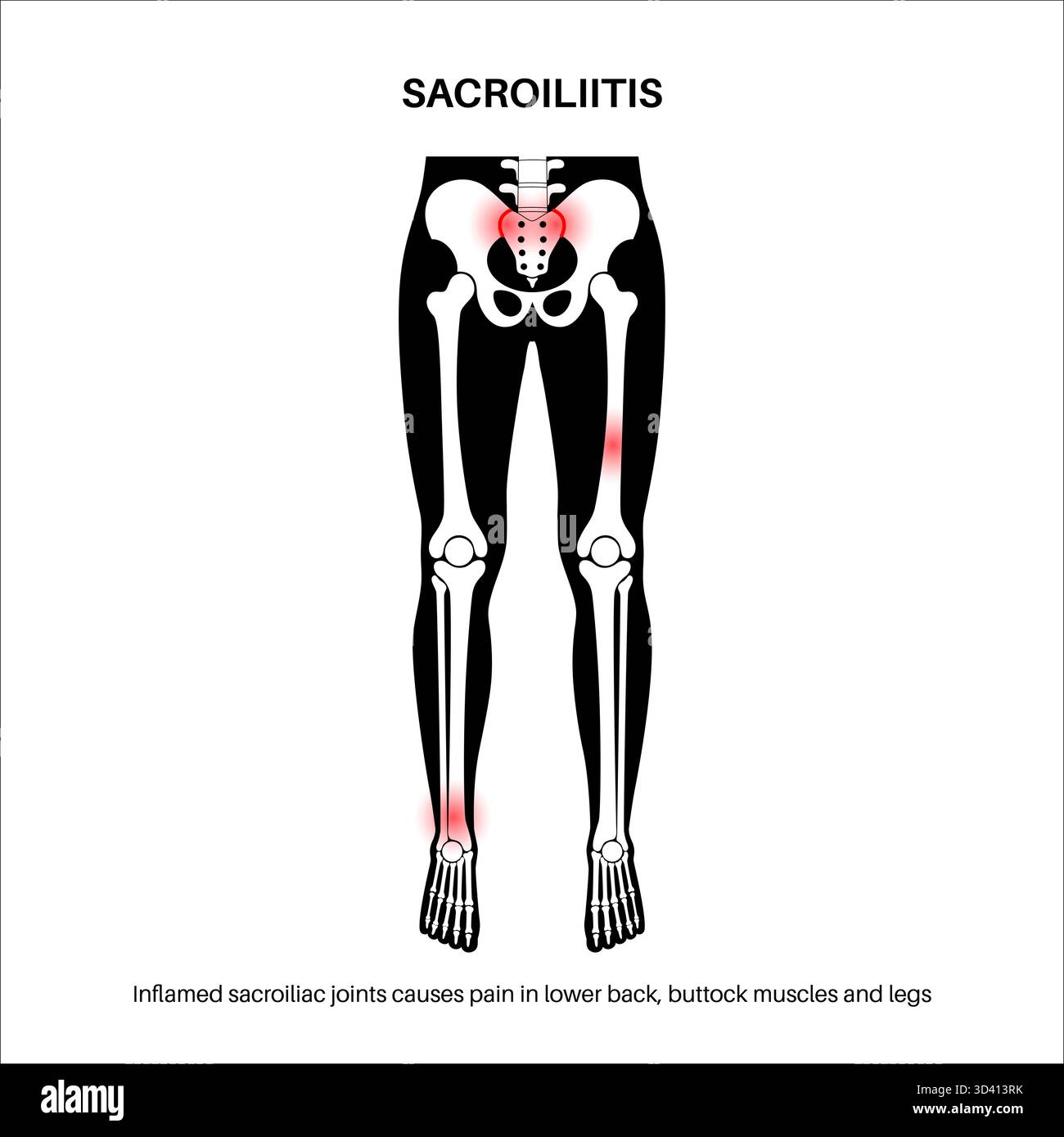 Illustration of sacroiliitis. This is an inflammatory condition that ...
