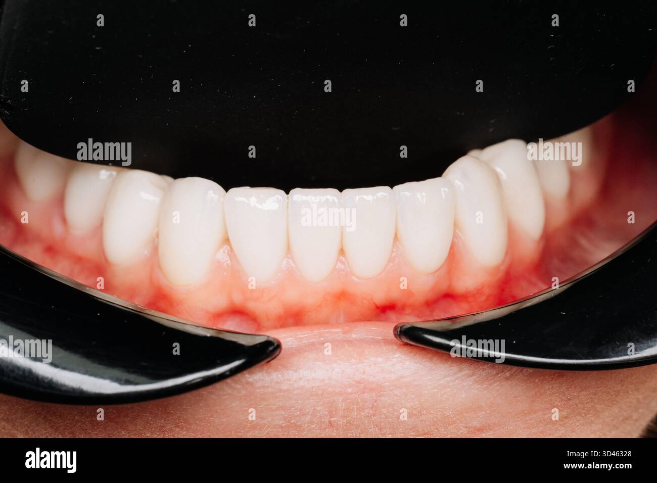 Macro view of lower porcelain veneers with pink gums and cheek ...