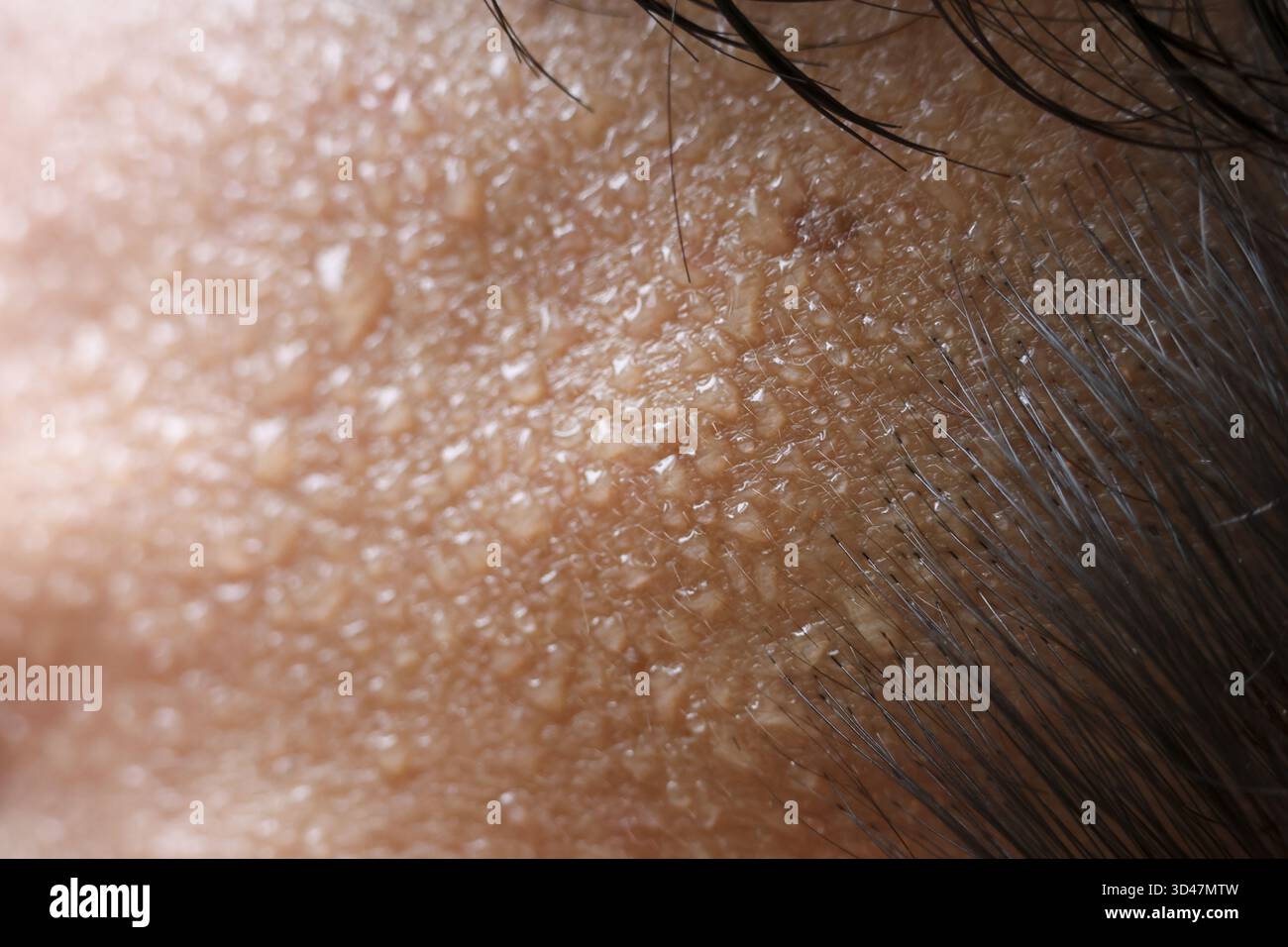 Close up of skin condition with many small bumps and papules on human ...
