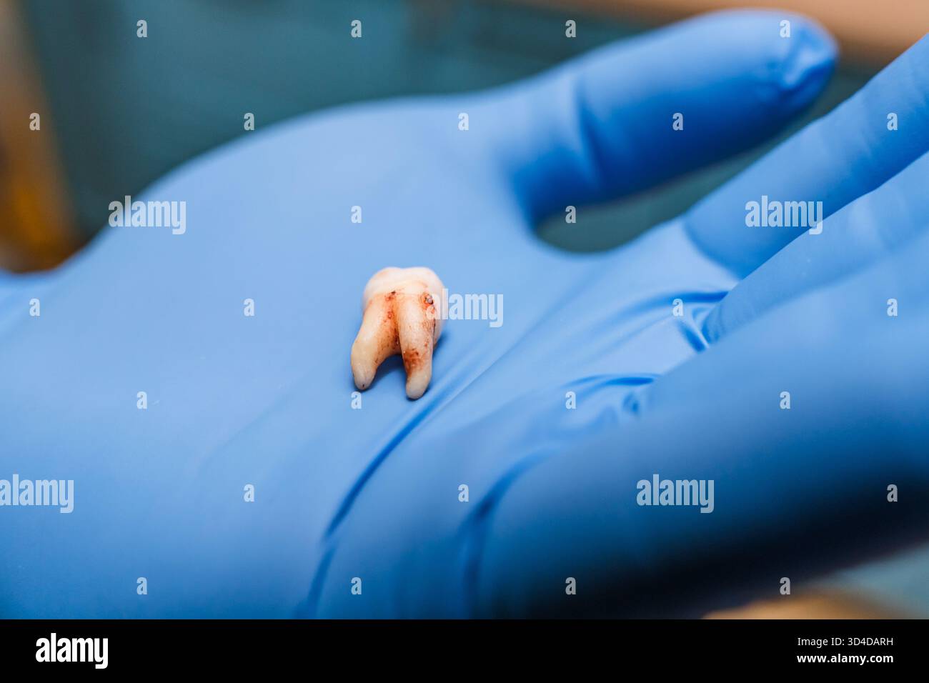 Human's tooth torn out after dentist surgery laying on the palm of the ...