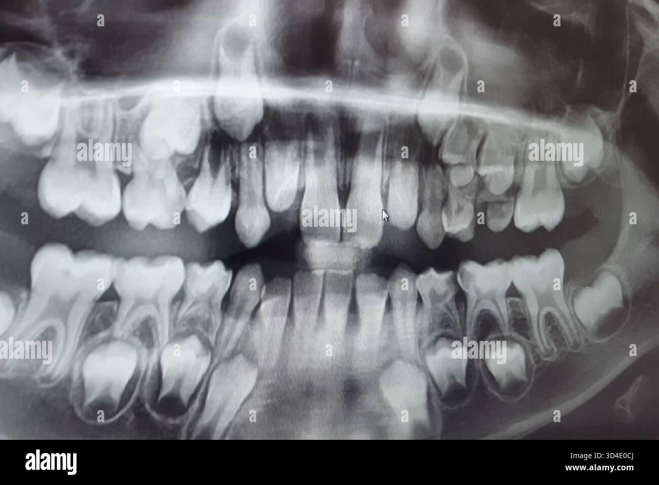 X-RAY PICTURE OF DAIRY AND NEW CHILDREN'S TEETH Stock Photo - Alamy