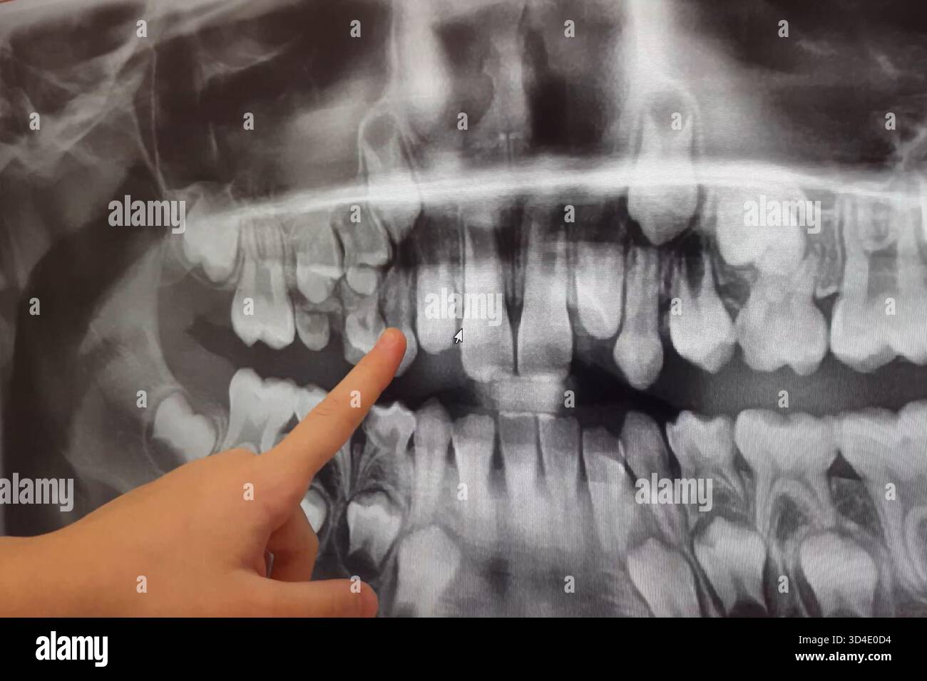 X-RAY PICTURE OF DAIRY AND NEW CHILDREN'S TEETH Stock Photo - Alamy