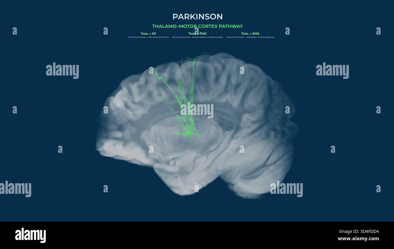 Parkinson dopamine loss reduces thalamo–motor cortex pathway excitation ...