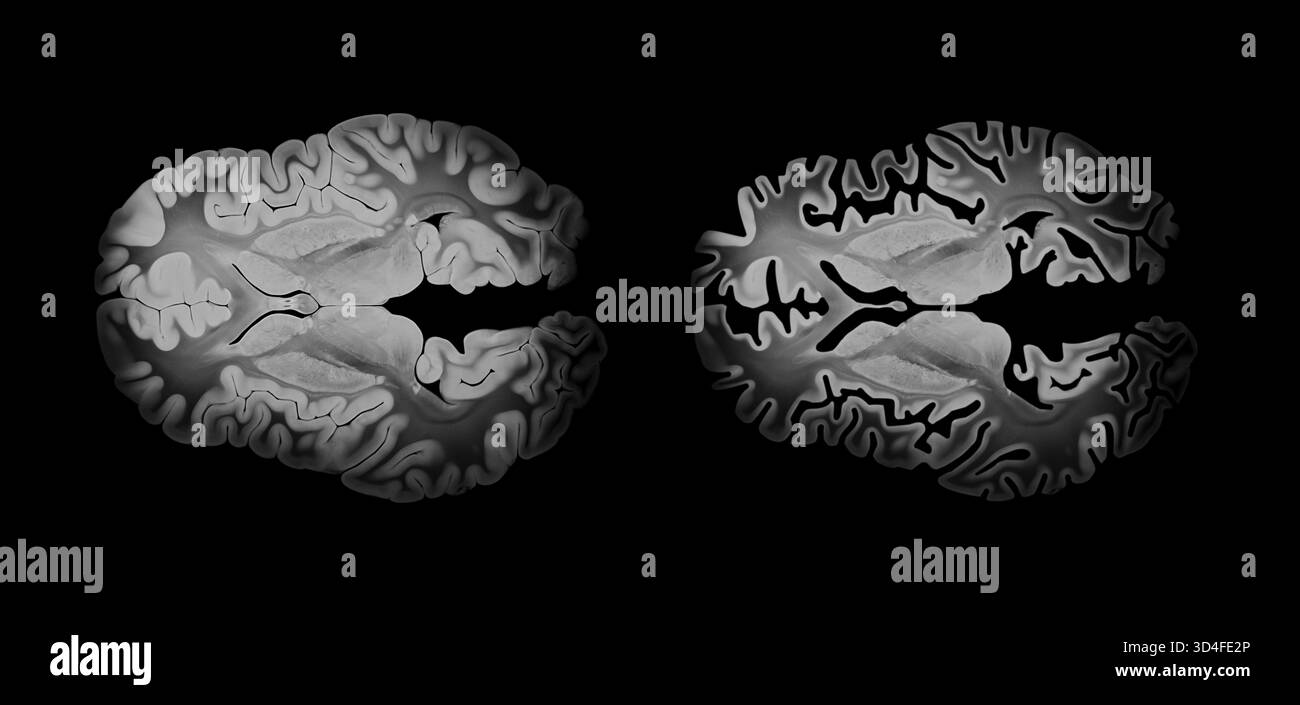 Alzheimer brain comparison hi-res stock photography and images - Alamy