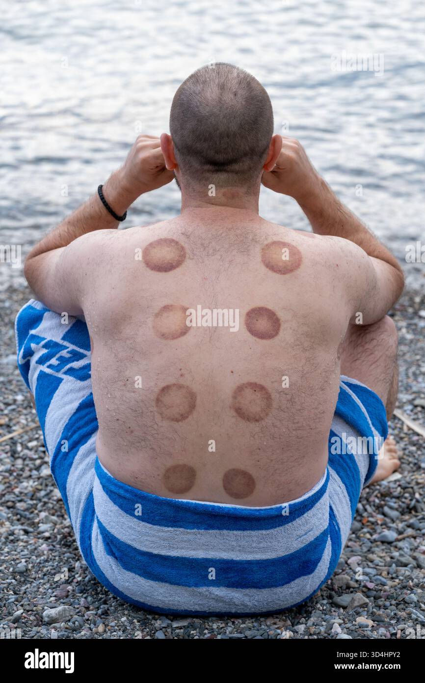 Cupping Marks by the Lakeside Stock Photo - Alamy