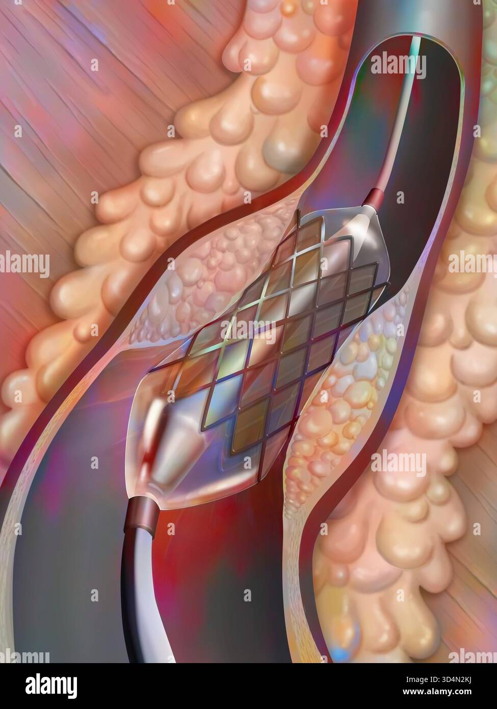 Angioplasty performed using a balloon catheter and a stent: balloon ...