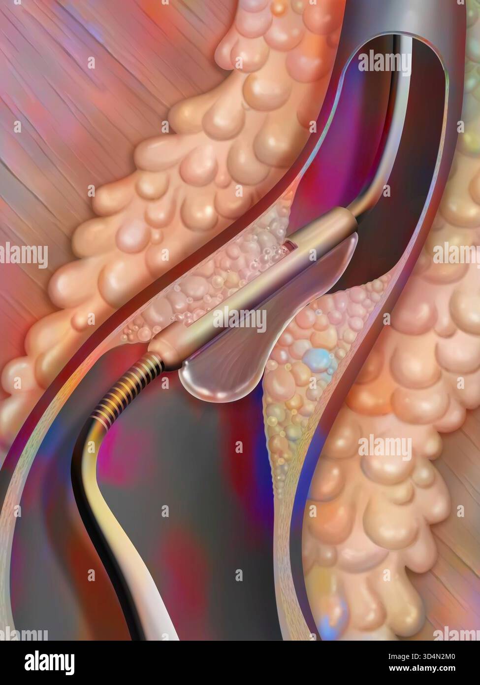 Directional atherectomy by a Simpson catheter. Made of a blade, which ...
