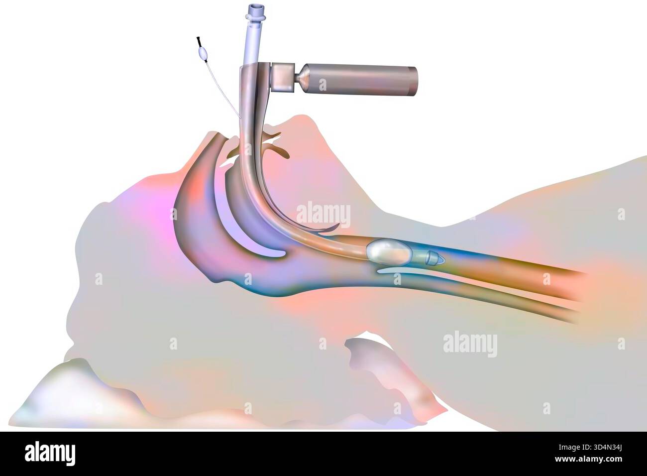 Tracheal intubation laryngoscope trachea hi-res stock photography and ...