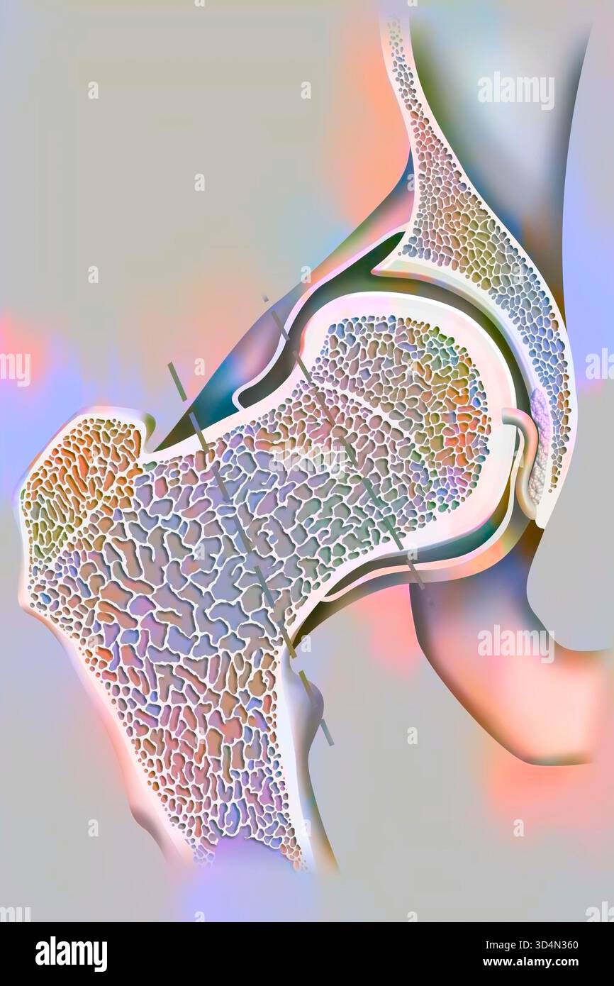 Basicervical femur fracture hi-res stock photography and images - Alamy