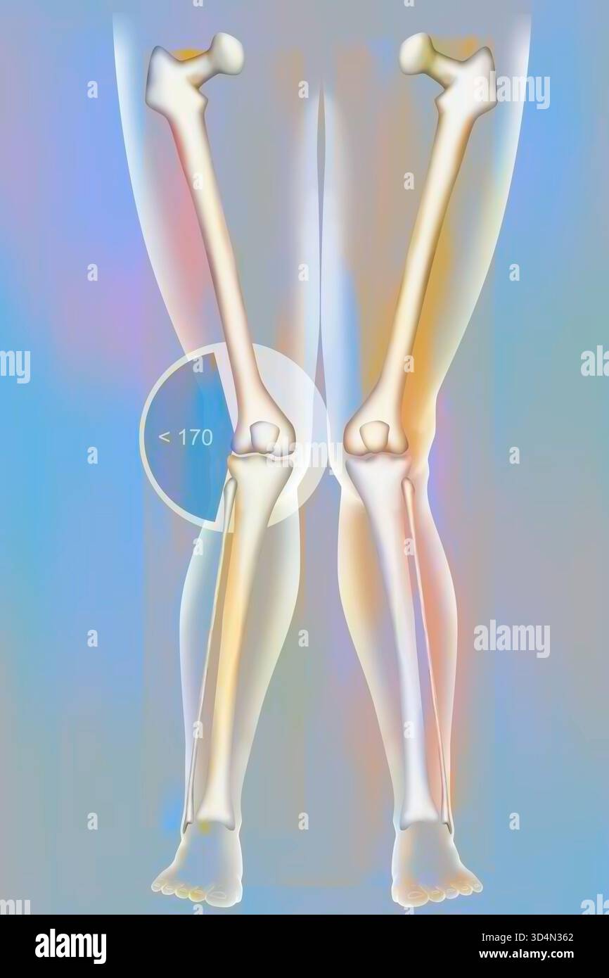 Genu valgum (knock knees Stock Photo - Alamy
