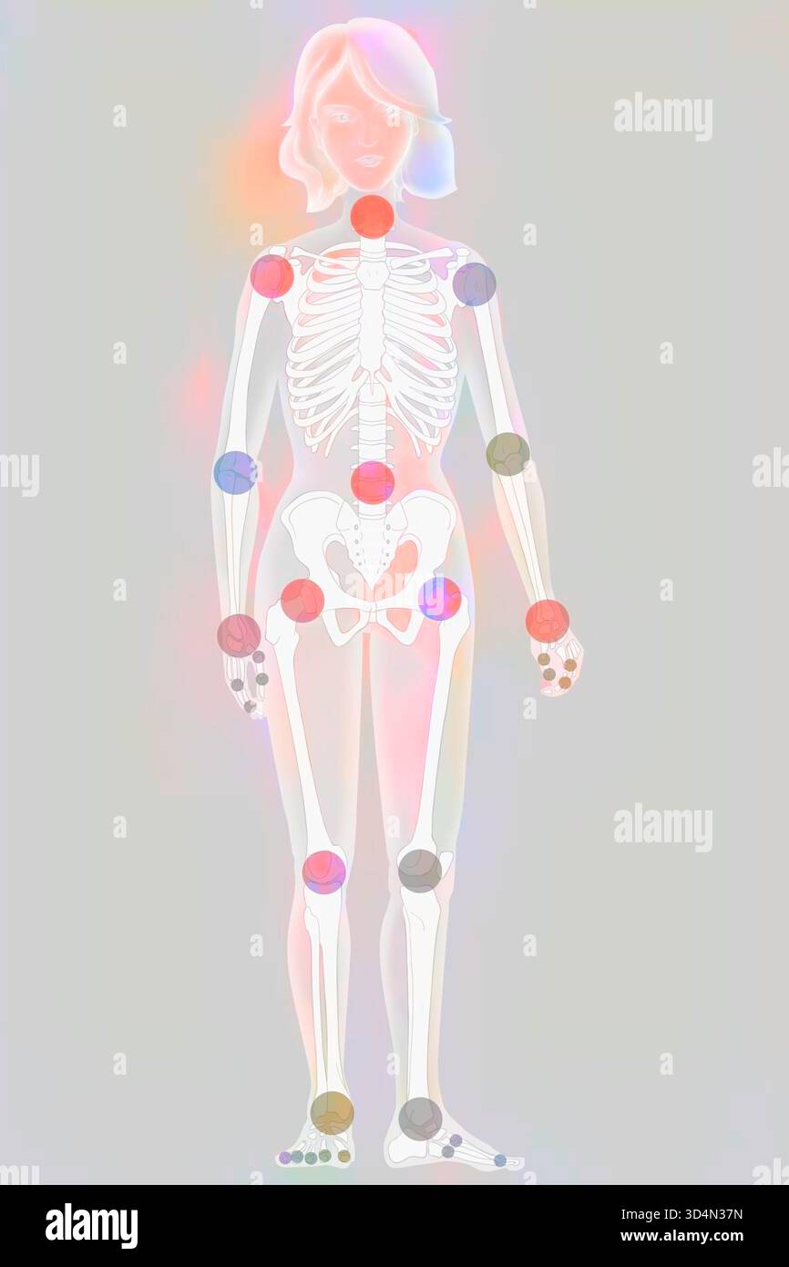 Areas of the body affected by osteoarthritis: - knee (gonarthrosis ...