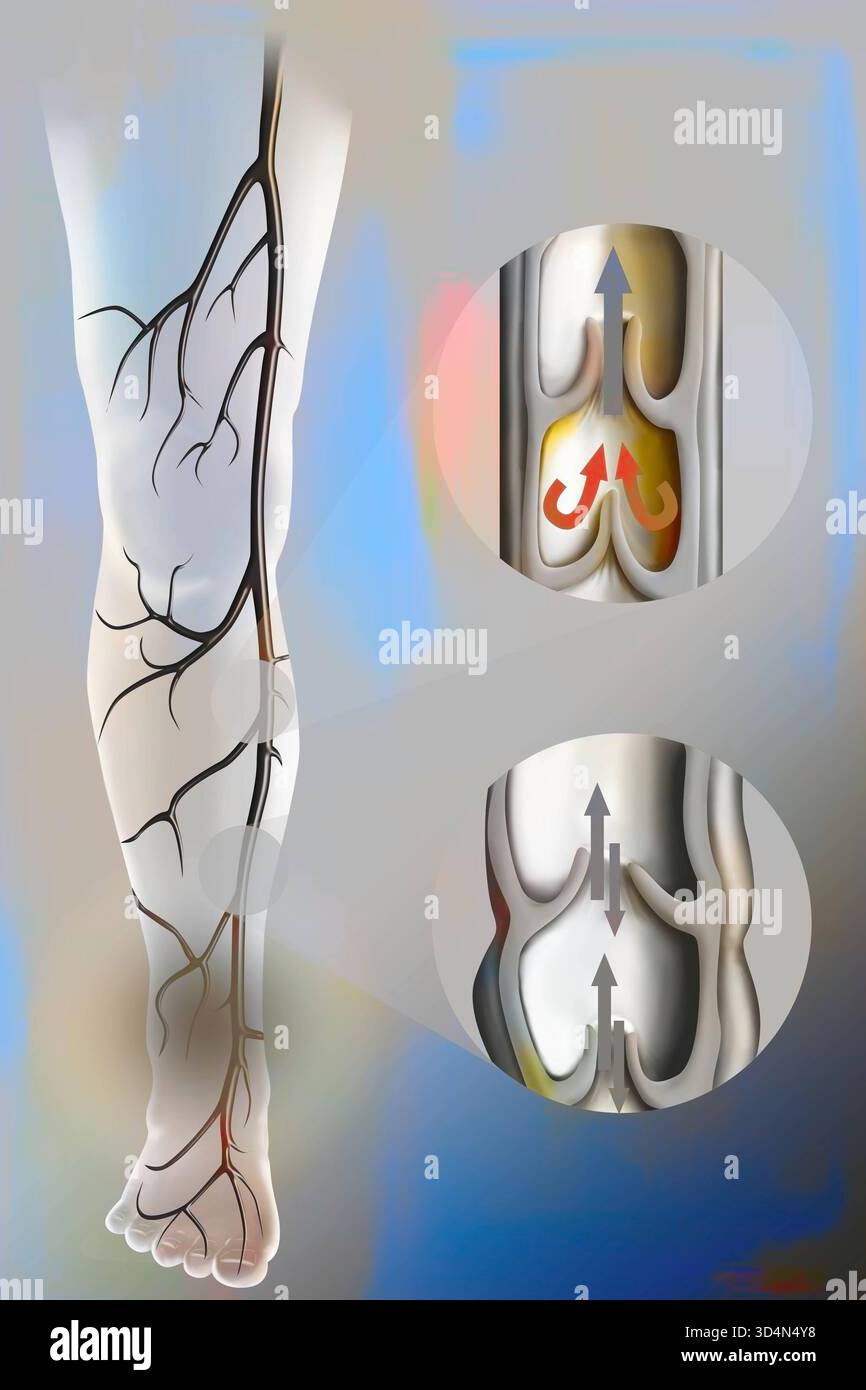Venous reflux. Veins ensure the return of deoxygenated blood to the ...