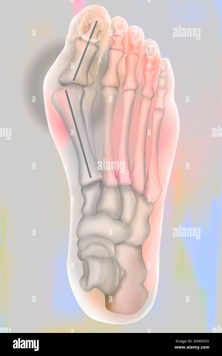 Hallux valgus bunion. Hallux valgus is an outward deviation of the big ...