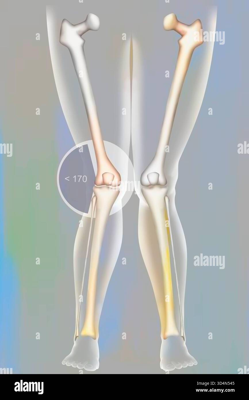 Genu valgum knock knees. Genu valgum is a deformity of the lower limb ...