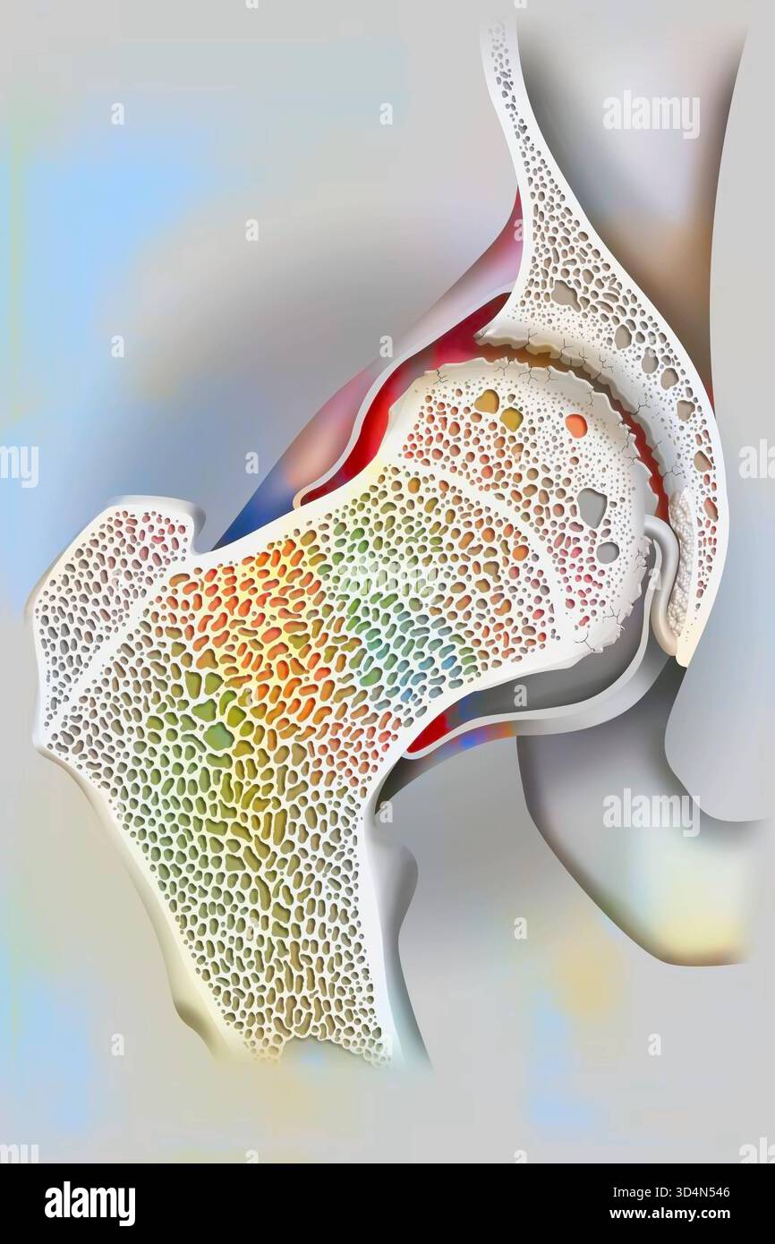 Hip osteoarthritis femoral head and acetabulum. The cartilage at the ...