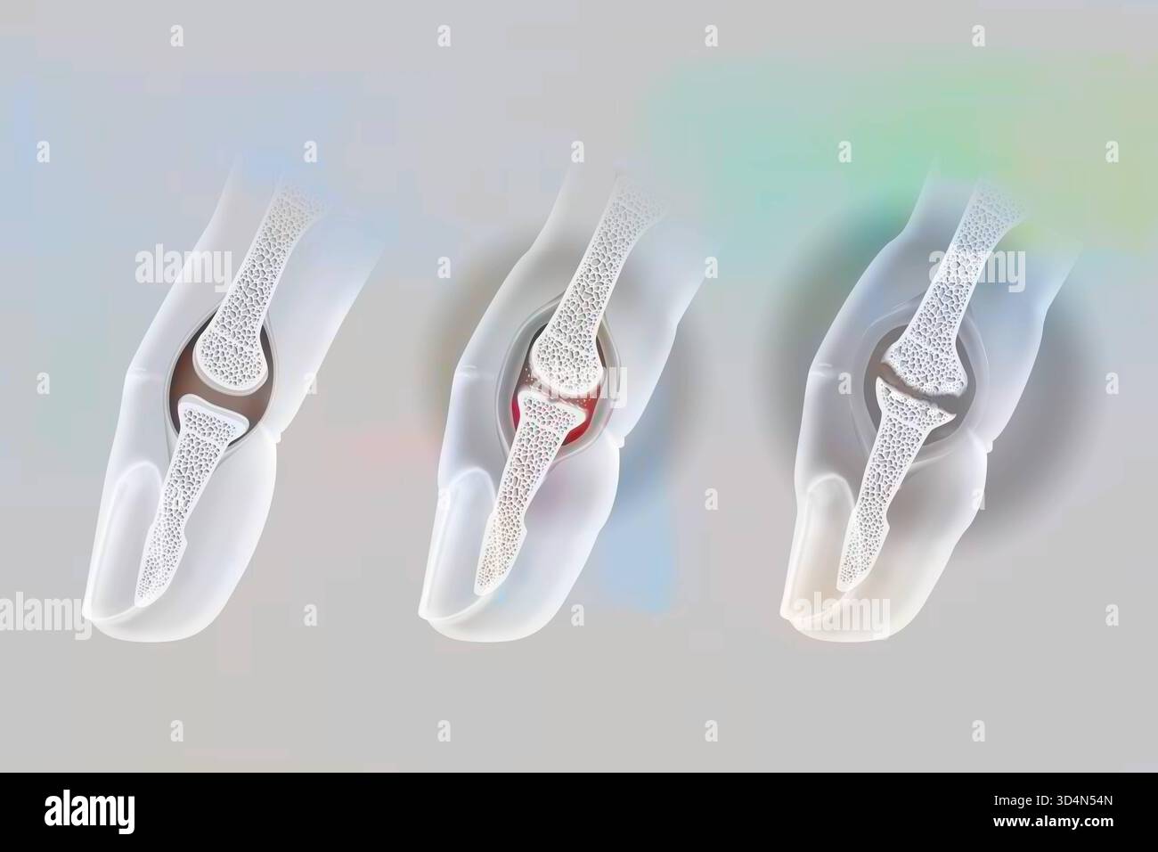 Finger osteoarthritis. Left: healthy joint. Middle: moderate ...