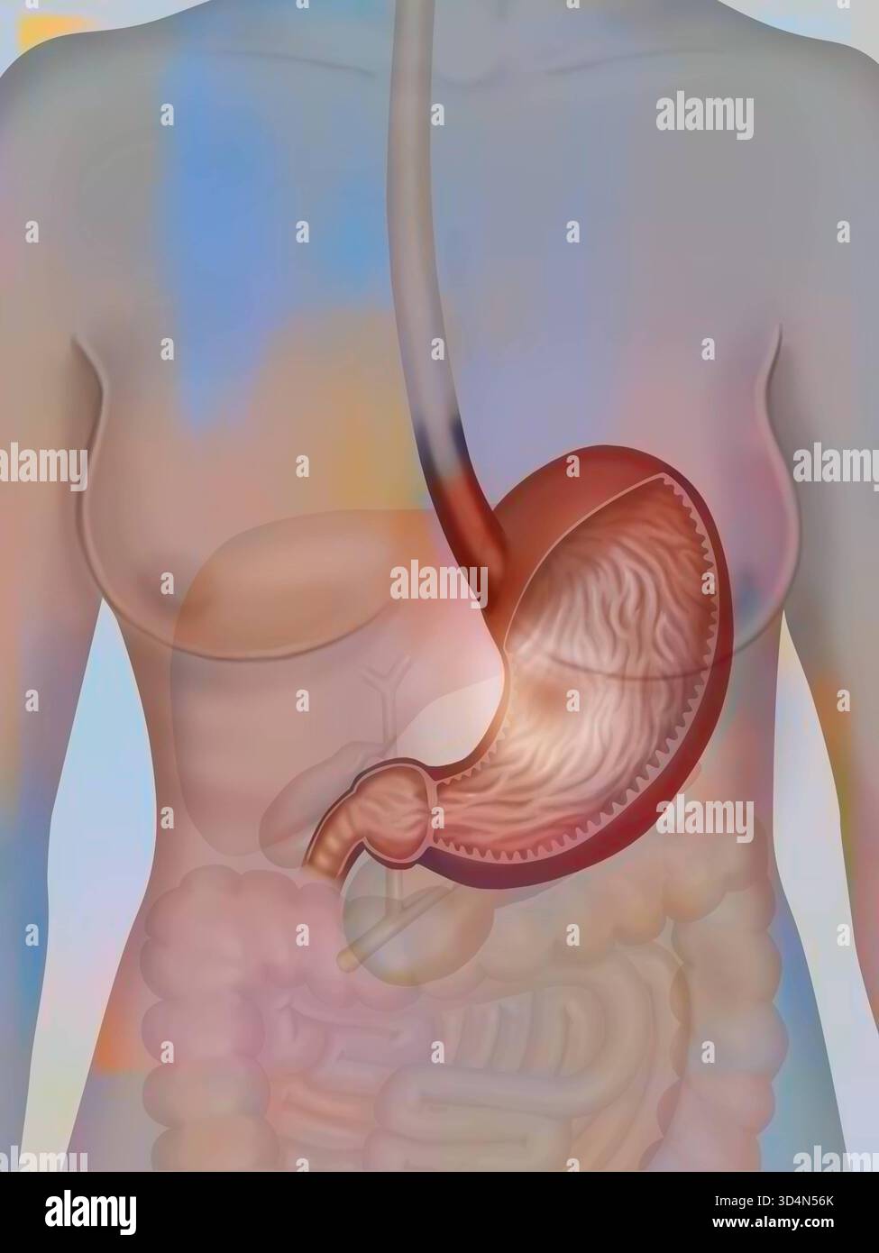 Illustration of stomach disorders: gastric ulcer, gastritis, heartburn ...