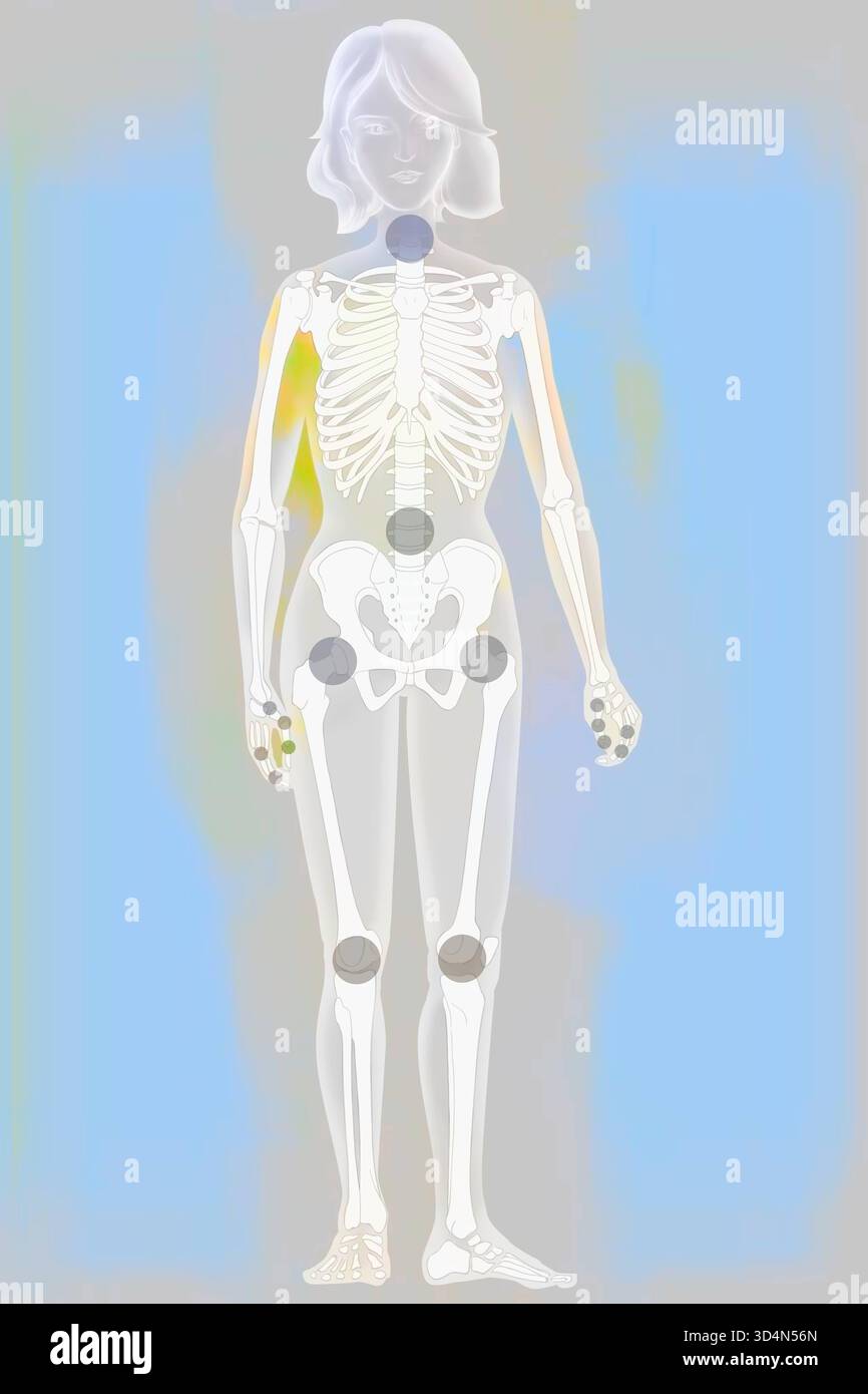 Areas of the body affected by osteoarthritis: - knee gonarthrosis ...