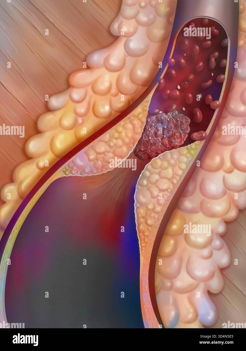Artery blocked by a thrombus caused by an atheromatous plaque. Here, an ...