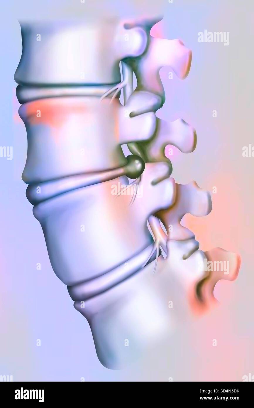 Herniated disc. A herniated disc is a protrusion of an intervertebral ...