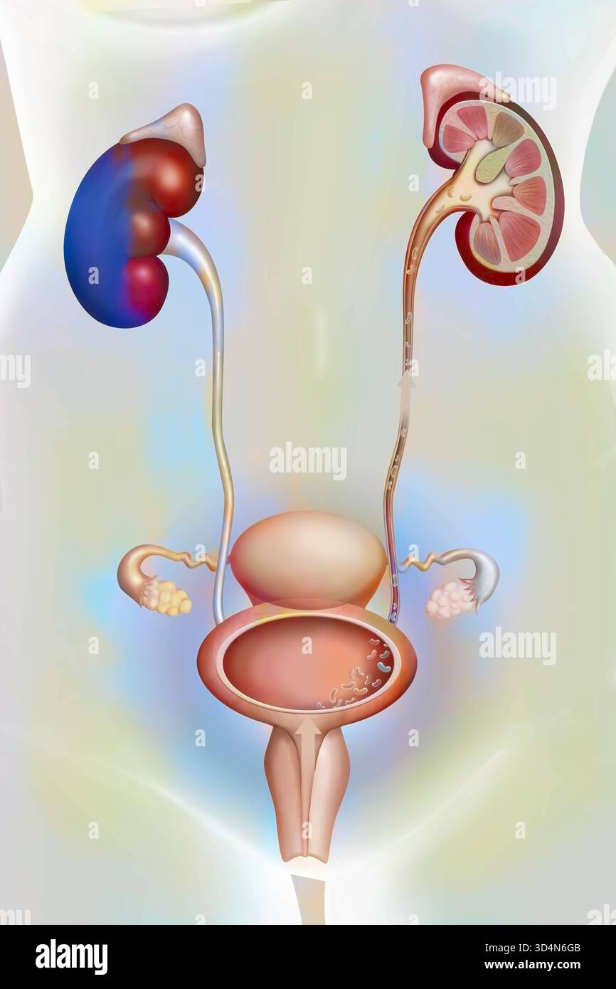 Pyelocystitis. The infection of the bladder cystitis by bacteria has ...
