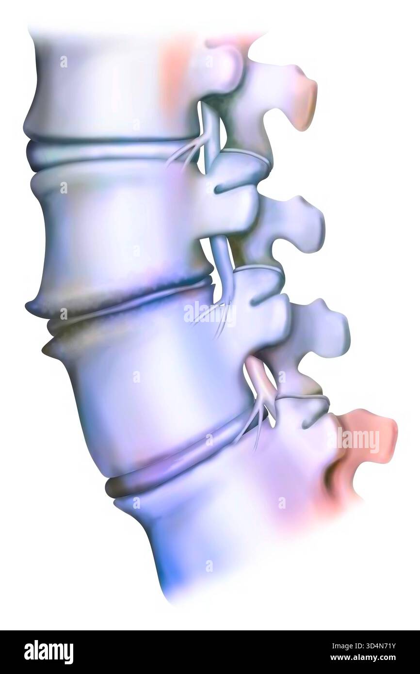 Spondyloarthrosis of the lumbar vertebrae lumbar osteoarthritis, with ...