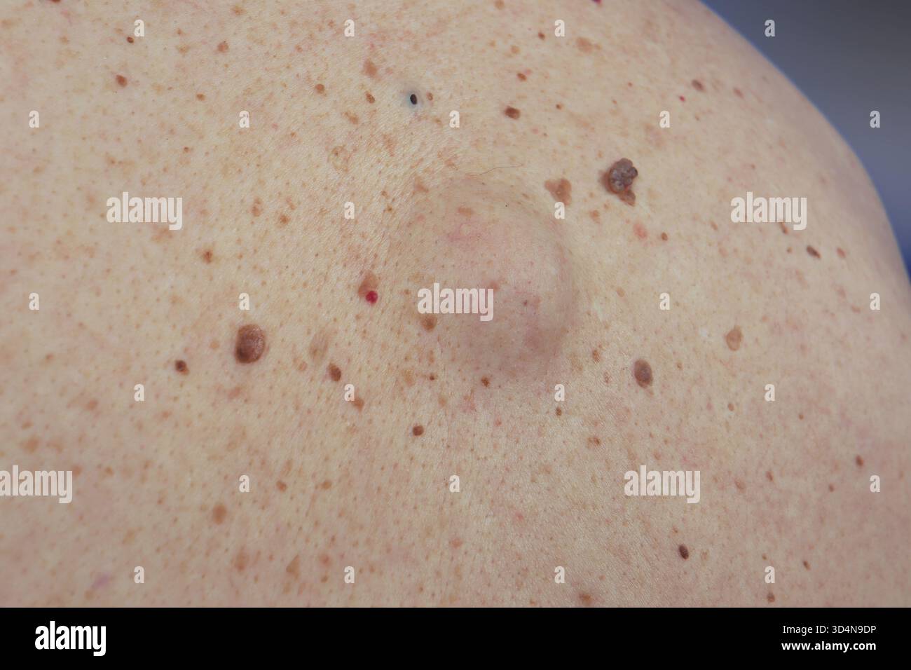 Sebaceous cyst of the back in an 85-year-old man Stock Photo - Alamy