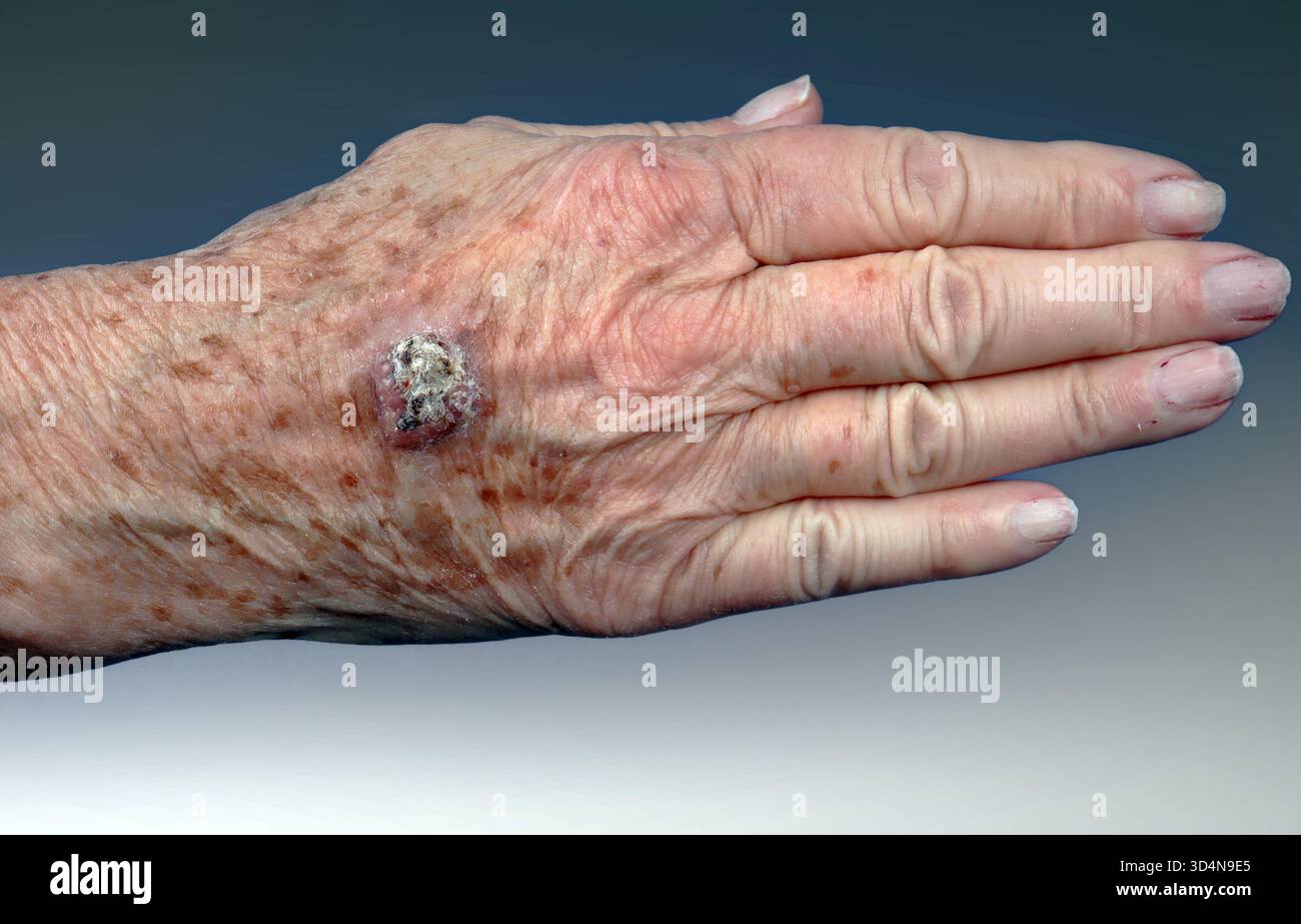 Well-differentiated squamous cell carcinoma of the dorsal aspect of the ...