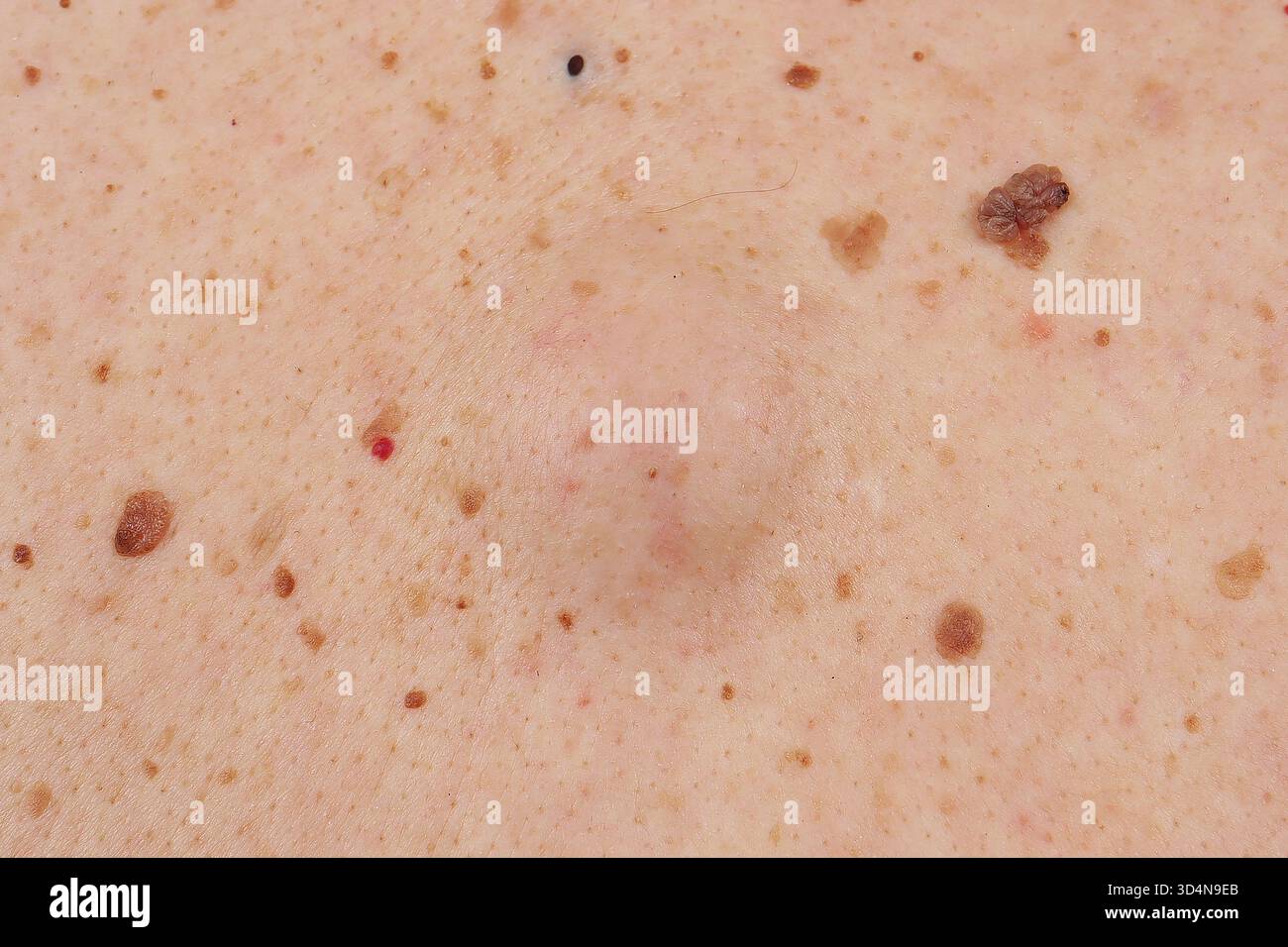 Sebaceous cyst back in hi-res stock photography and images - Alamy