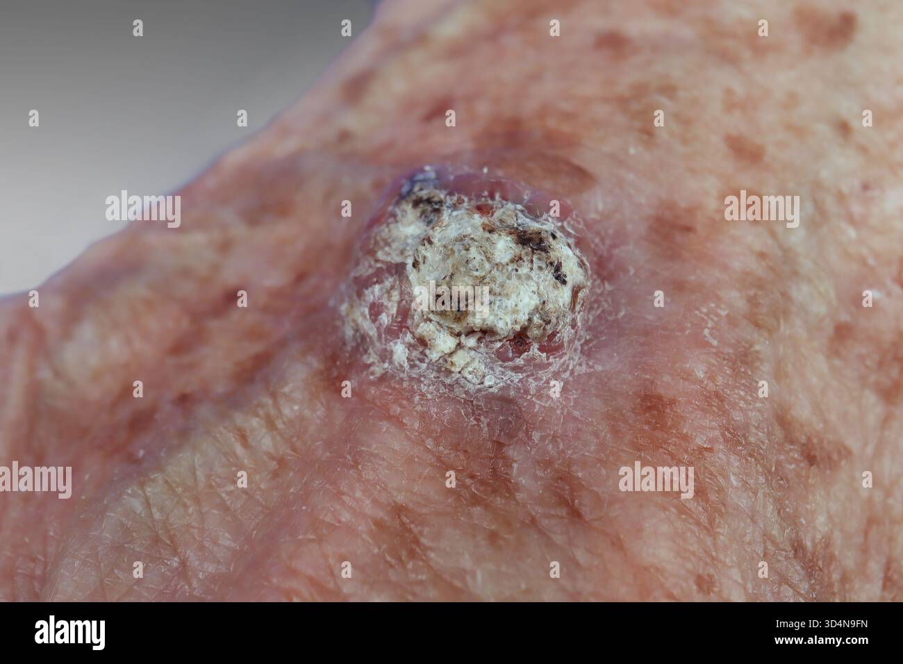 Well-differentiated squamous cell carcinoma of the dorsal aspect of the ...