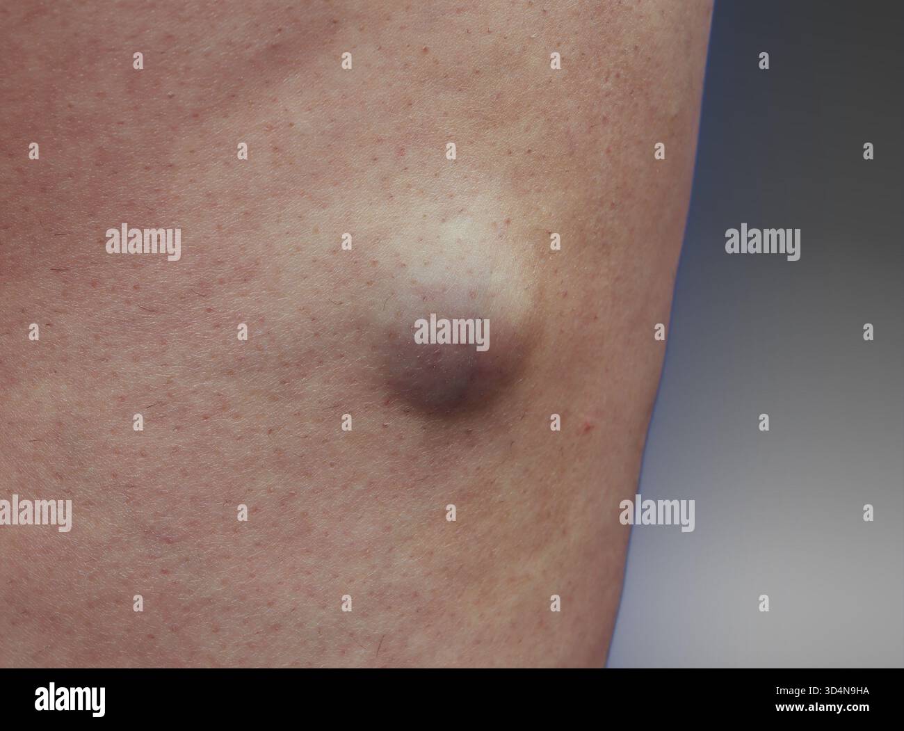 Sebaceous cyst of the thigh in a 50-year-old woman Stock Photo - Alamy